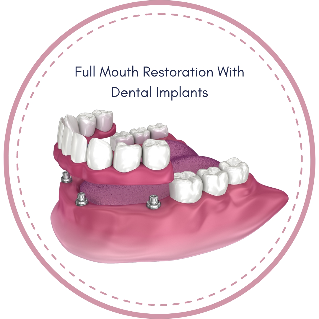 Transform Smiles: Full-mouth dental implants in Shepperton